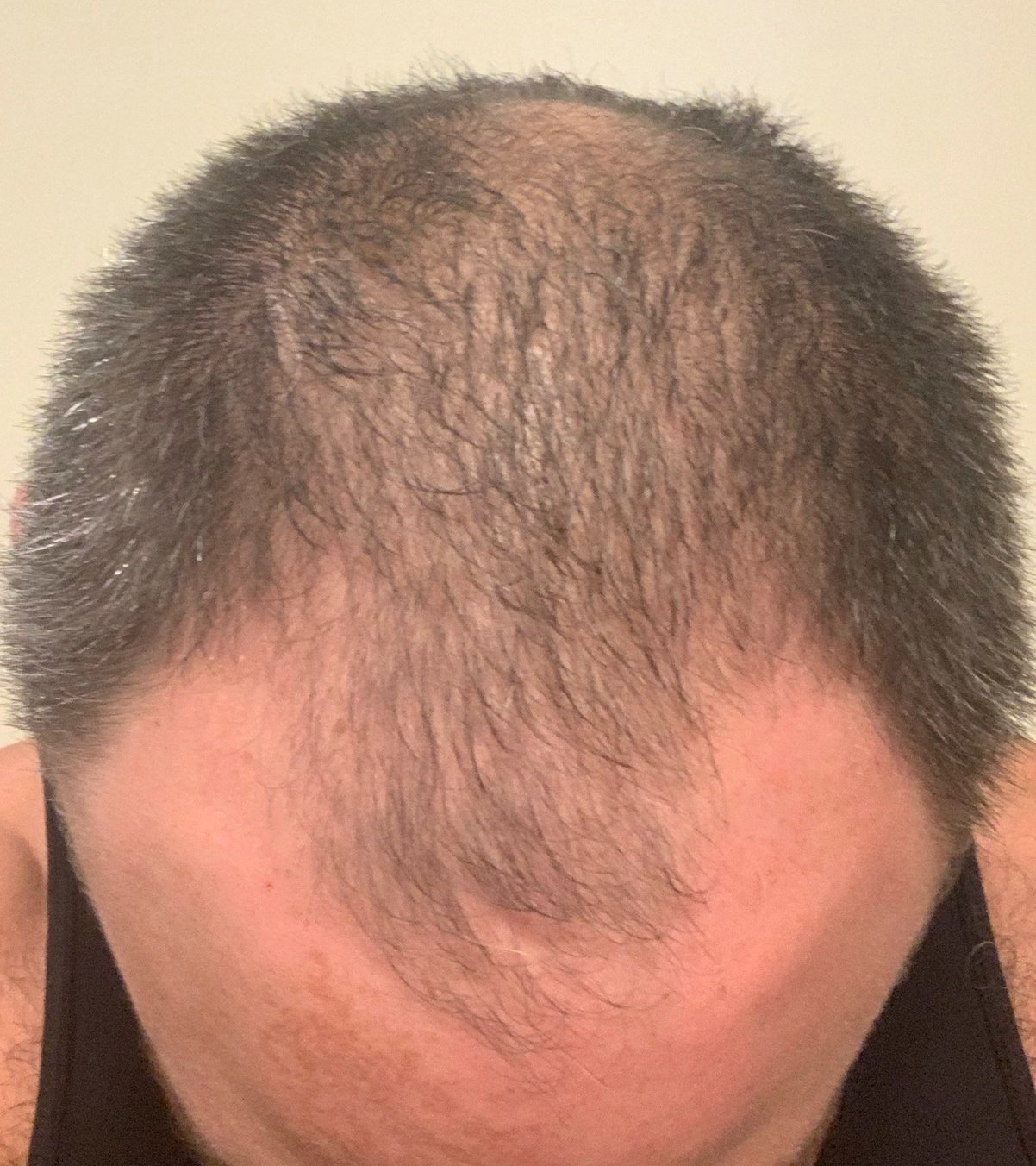 4,000 FUE with Dr. Wong 39 NW4, Booked for Early October - Hair ...