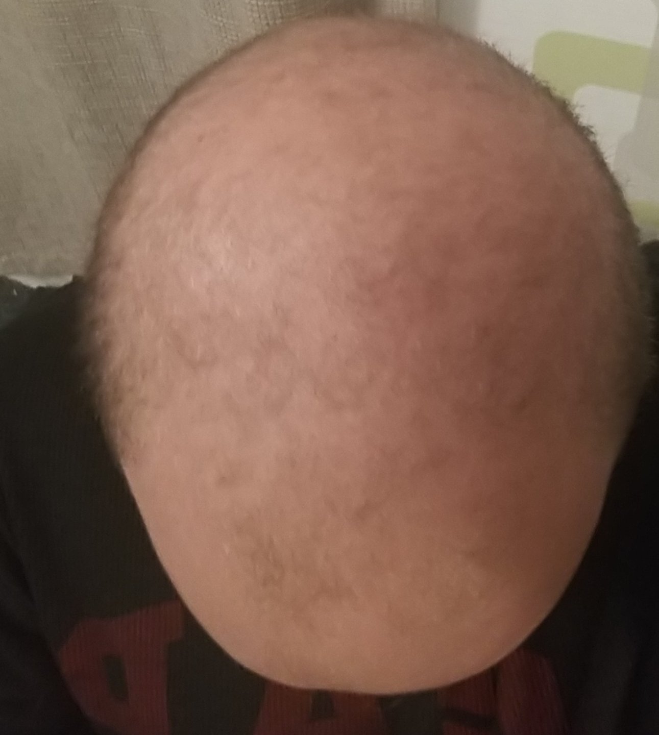 Aggressive hair loss at a young age. Am I a candidate for a hair ...
