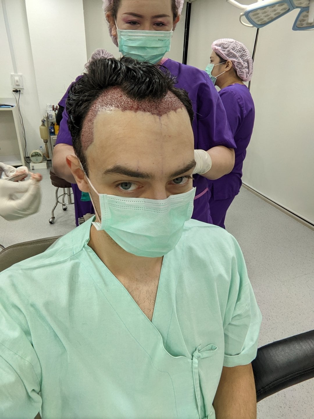 2770 FUT (NW3.5, hairline, temporal points) with Dr Pathomvanich (Dr ...