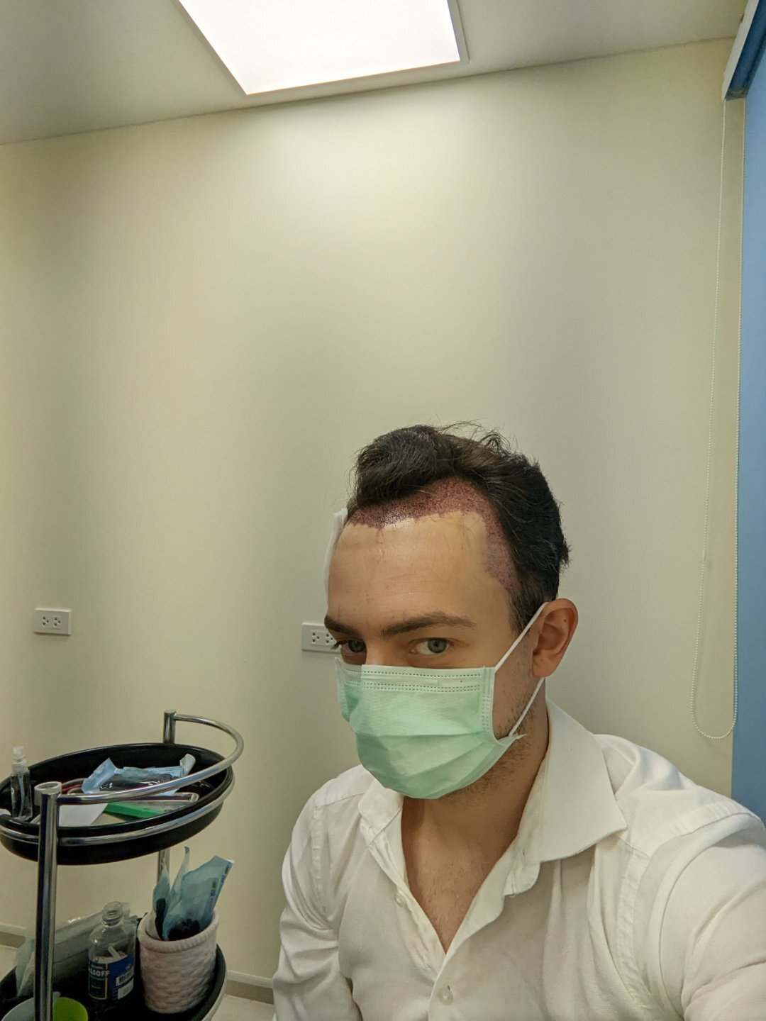 2770 FUT (NW3.5, hairline, temporal points) with Dr Pathomvanich (Dr ...