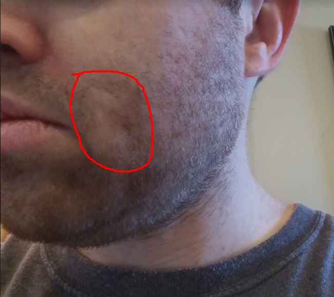 Beard Bald Patch Causes - Hair Restoration Questions and Answers - Hair ...