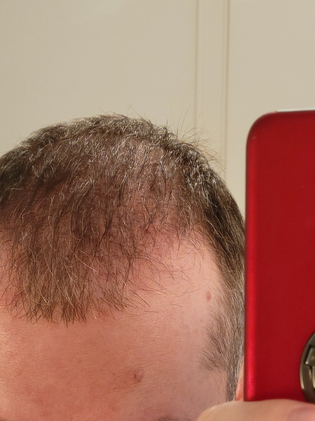 Dr Michael Wolfeld (NYC) review - Hair Restoration Questions and ...
