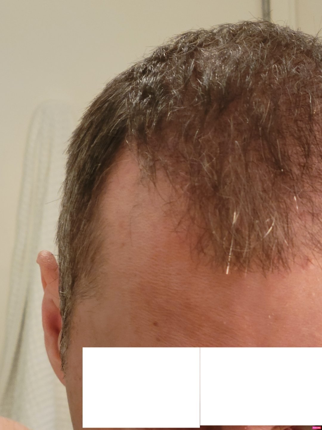 Dr Michael Wolfeld (NYC) review - Hair Restoration Questions and ...