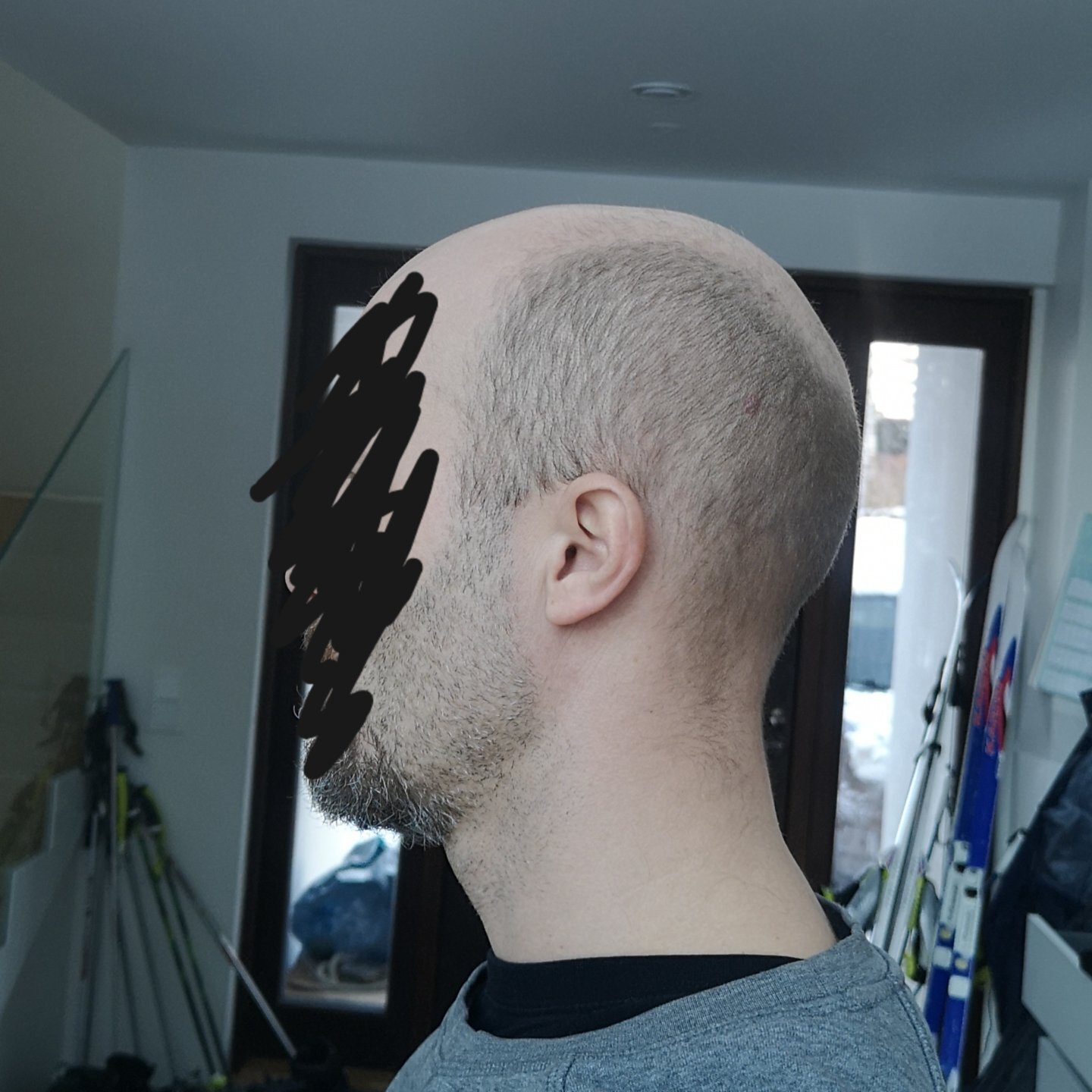 Is my donor good, NW7 - Hair Restoration Questions and Answers - Hair ...
