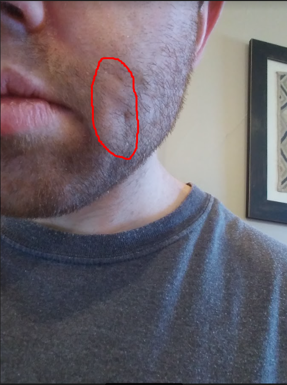 Beard Bald Patch Causes - Hair Restoration Questions and Answers - Hair ...