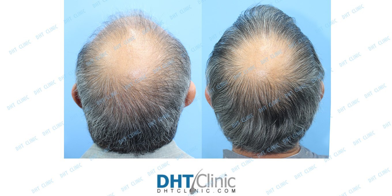 Dr. Damkerng Pathomvanich (DHT Clinic) / Restoration of frontal ...