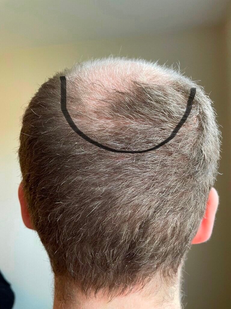 I’ve heard mixed reviews on Eugenix - Page 3 - Hair Restoration ...