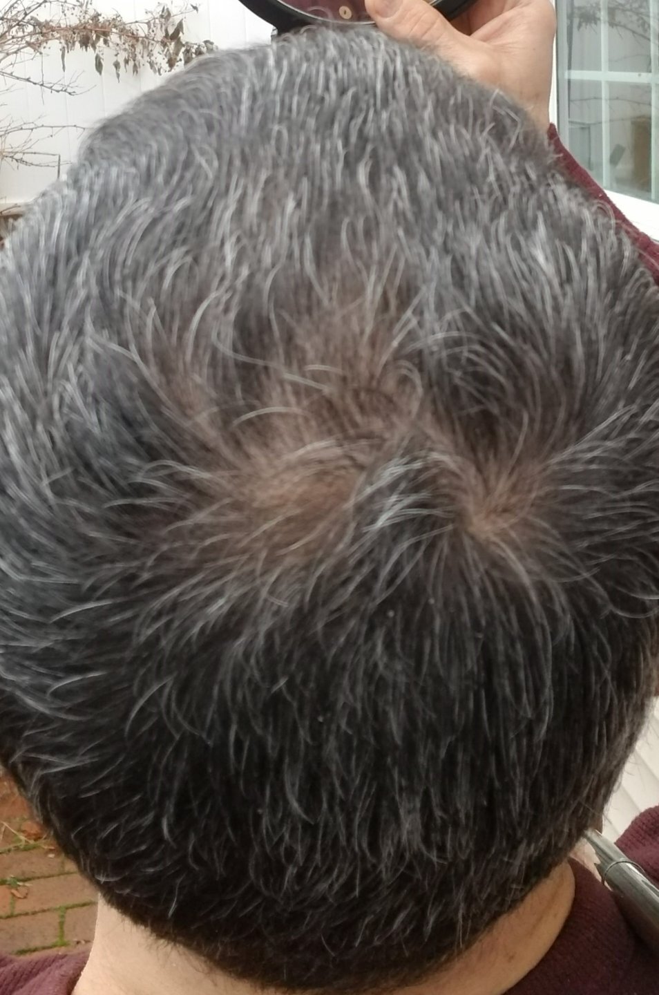 Eugenix, NW3 5200 + grafts / MazAB's 2nd procedure on 10/8/2022 by Dr ...