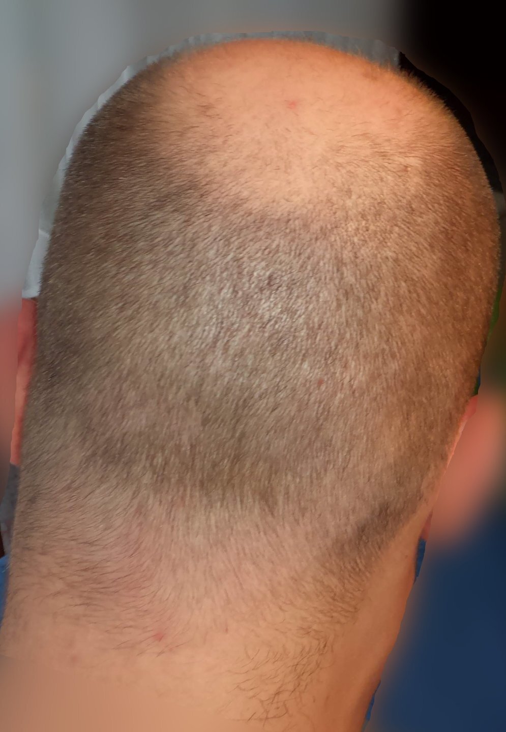 NW7 wants to frame the face - realistic goals FUE+SMP ? - Hair ...