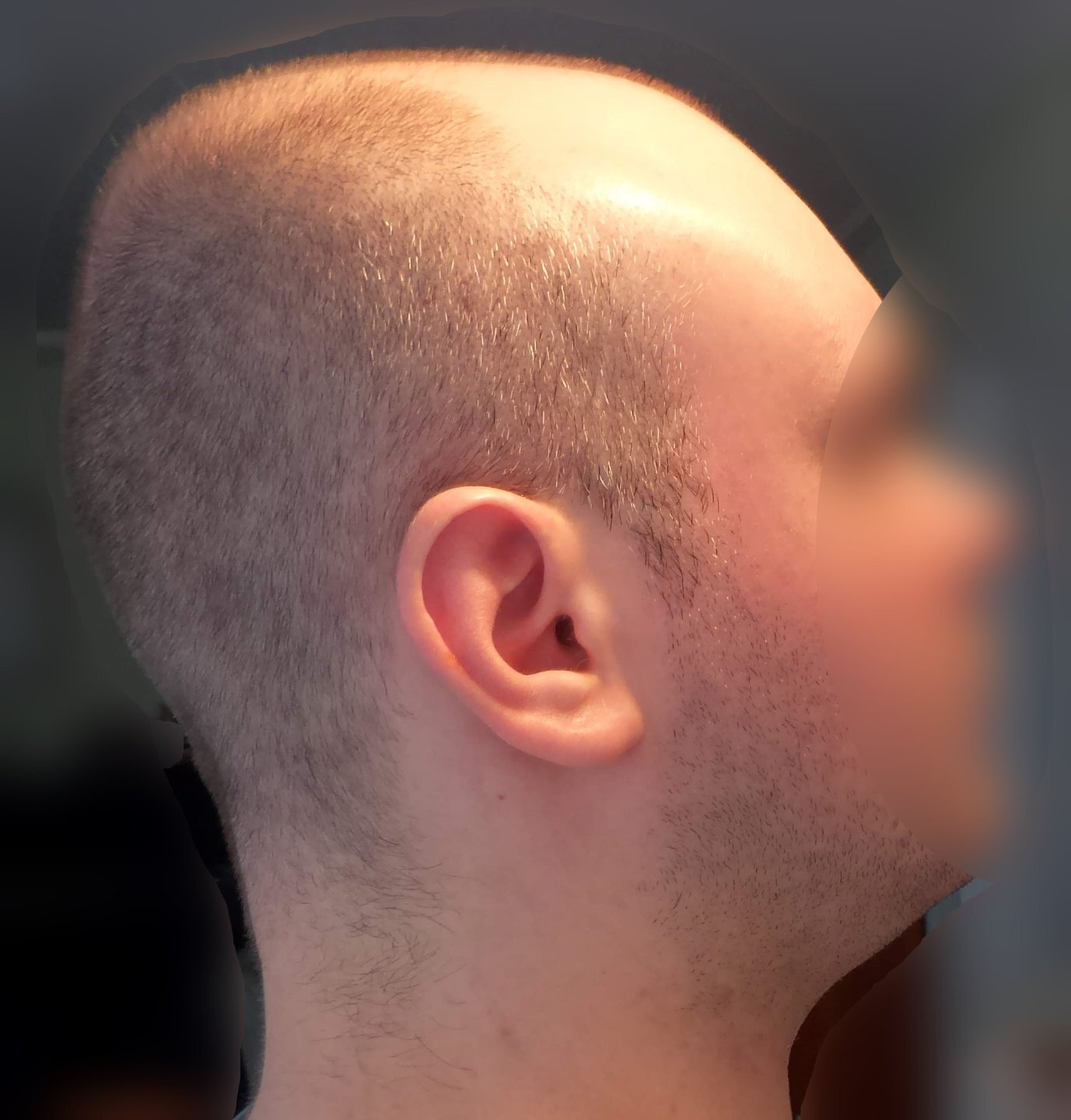 NW7 wants to frame the face - realistic goals FUE+SMP ? - Hair ...