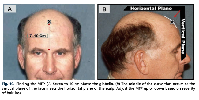 The art of frontal hairline and temple point design - Hair Restoration ...