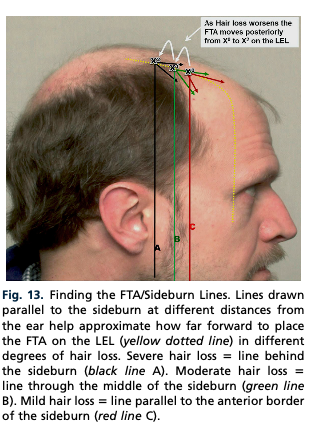 The art of frontal hairline and temple point design - Hair Restoration ...