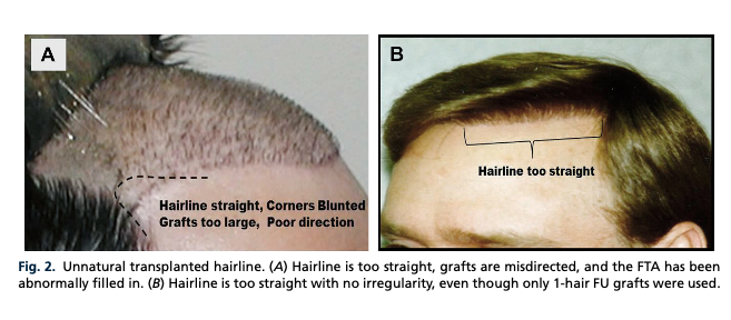 The art of frontal hairline and temple point design - Hair Restoration ...
