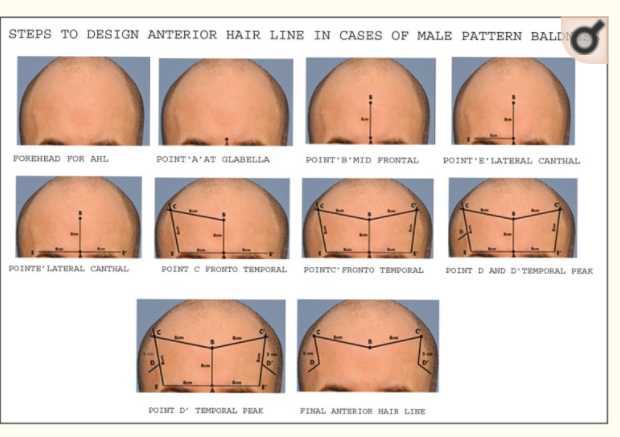 The art of frontal hairline and temple point design - Hair Restoration ...