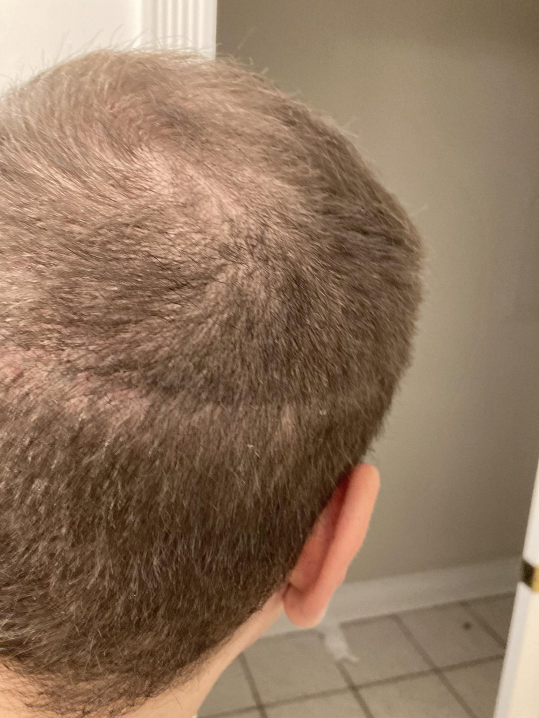 Keloid Scar from FUT - Open Hair Loss Topics - Hair Restoration Network ...