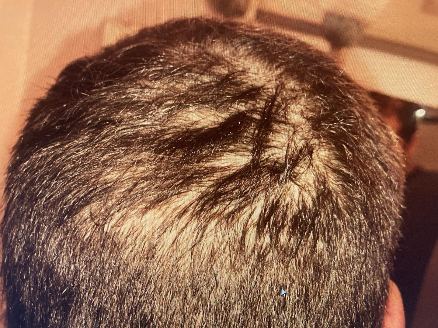 Keloid Scar from FUT - Open Hair Loss Topics - Hair Restoration Network ...