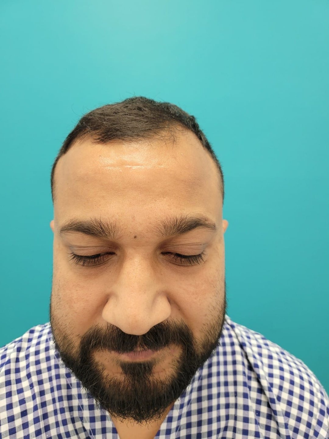 15 Month results - 2542 Grafts at Medlinks with Dr Gaurang Krishna ...