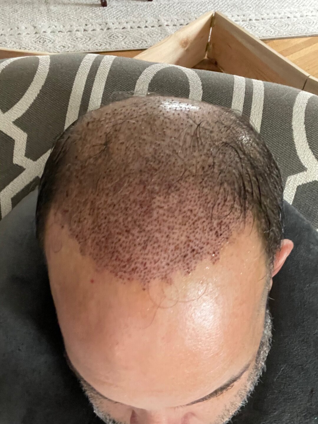 Dr Michael Wolfeld (NYC) review - Page 2 - Hair Restoration Questions ...