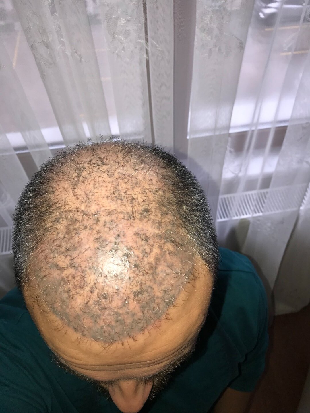 Botched smp problem laser removal is not the best option! For all ...