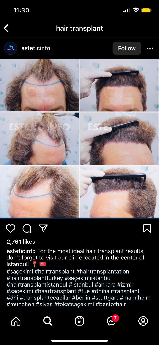 Thieves in the Industry - Hair Restoration Questions and Answers - Hair ...
