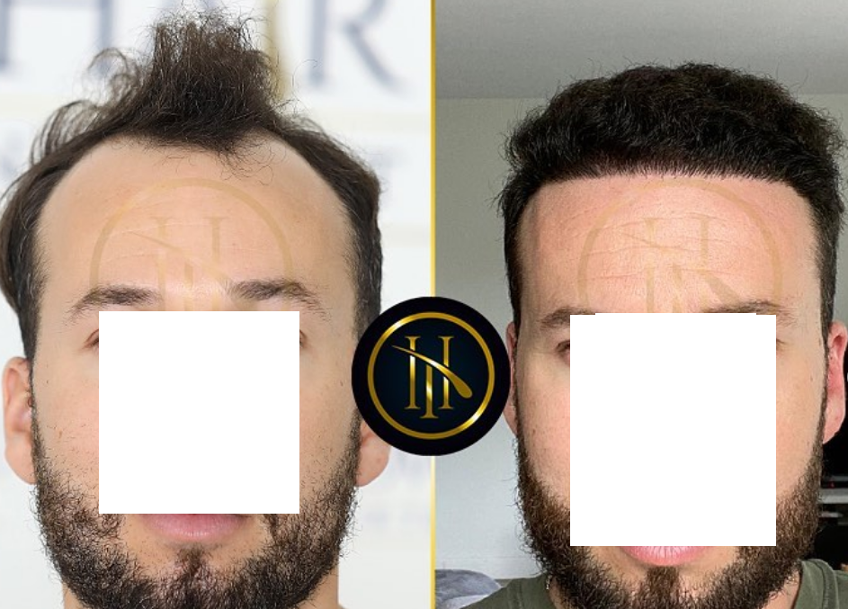 Hair transplant in Turkey(?) - Hair Restoration Questions and Answers ...