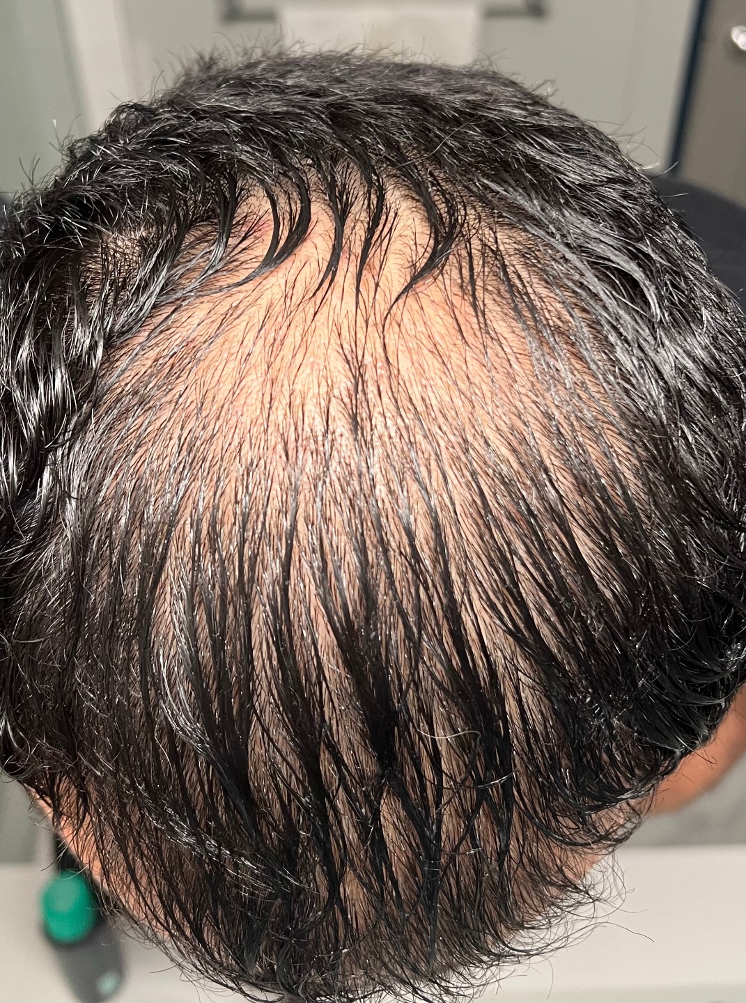 Starting Xyon (topical finastride) journey + HT - Hair Loss Drugs ...
