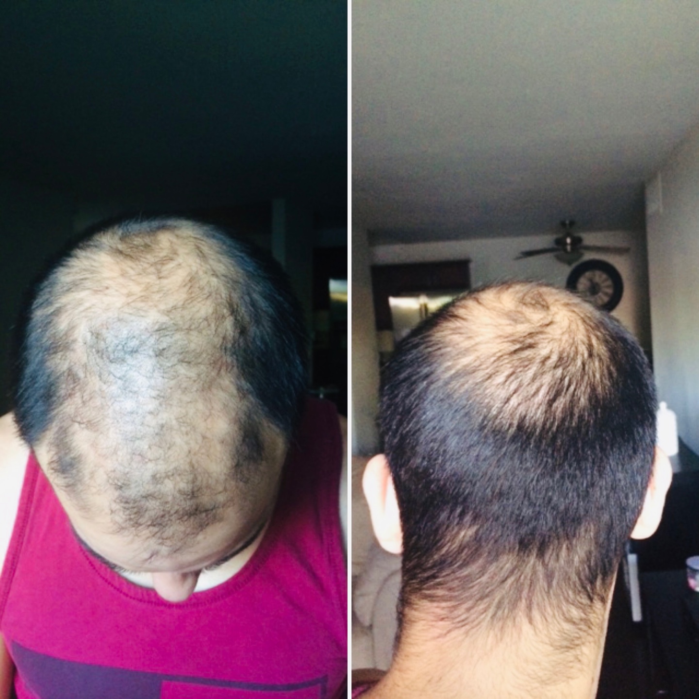 What age would you say your hair loss was the worst? - Hair Restoration ...