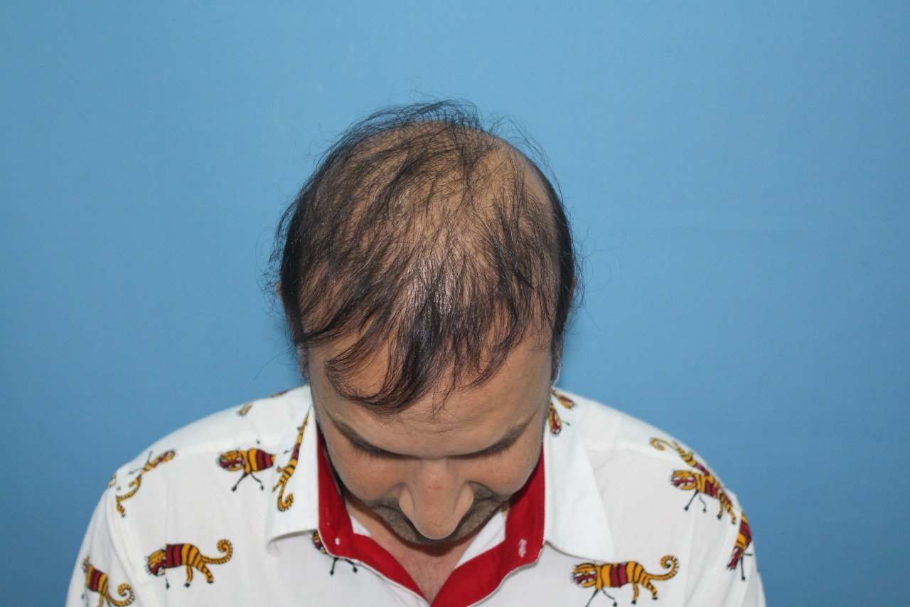 DISPLAYED ART OF 10,500 GRAFTS | NW7 | DR. SETHI | EUGENIX HAIR ...