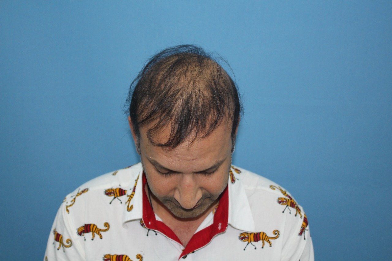 DISPLAYED ART OF 10,500 GRAFTS | NW7 | DR. SETHI | EUGENIX HAIR ...