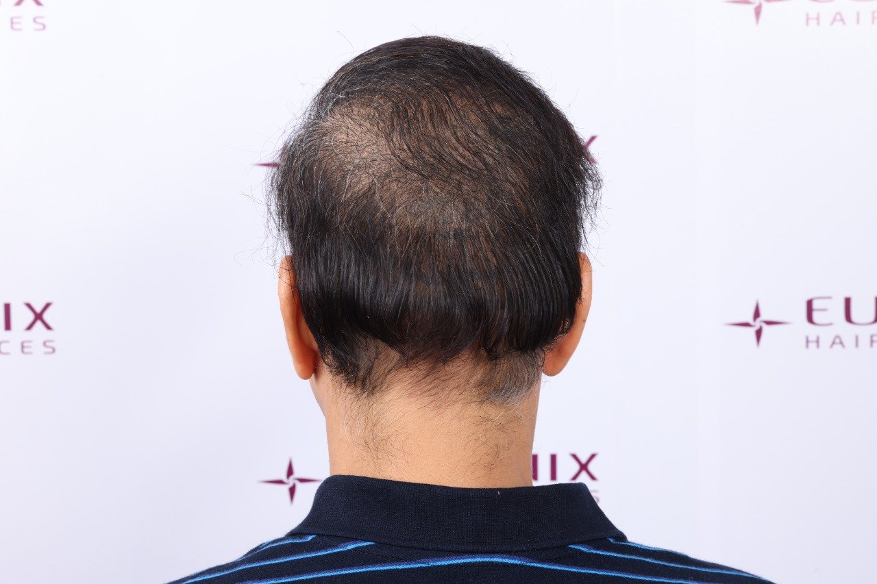 DISPLAYED ART OF 10,500 GRAFTS | NW7 | DR. SETHI | EUGENIX HAIR ...