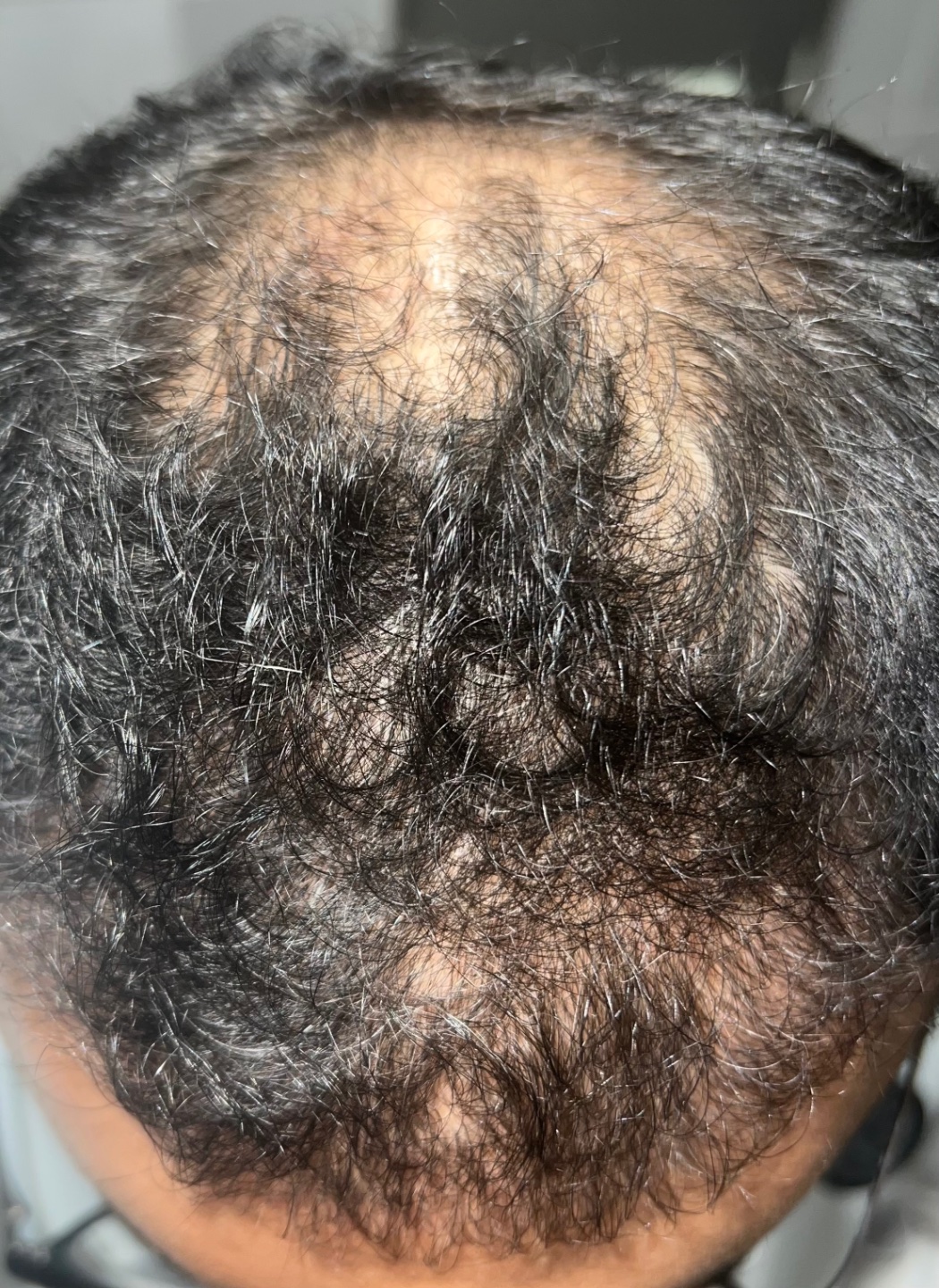 Starting Xyon (topical finastride) journey + HT - Hair Loss Drugs ...