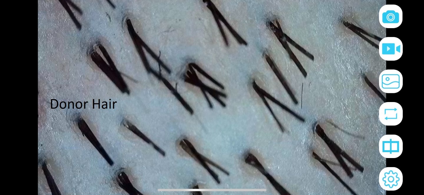 2 or 3 hairs growing from the same follicle - is that normal ? - Hair ...