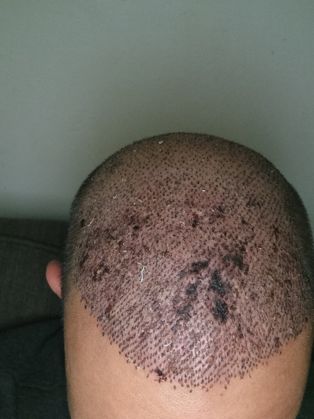 Scabs - Hair Transplant Reviews - Hair Restoration Network - Forum For ...