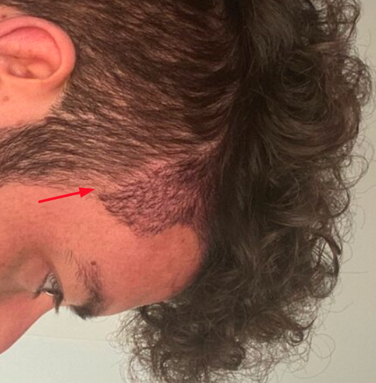 So self conscious about temporal points FUE - Hair Transplant Reviews ...