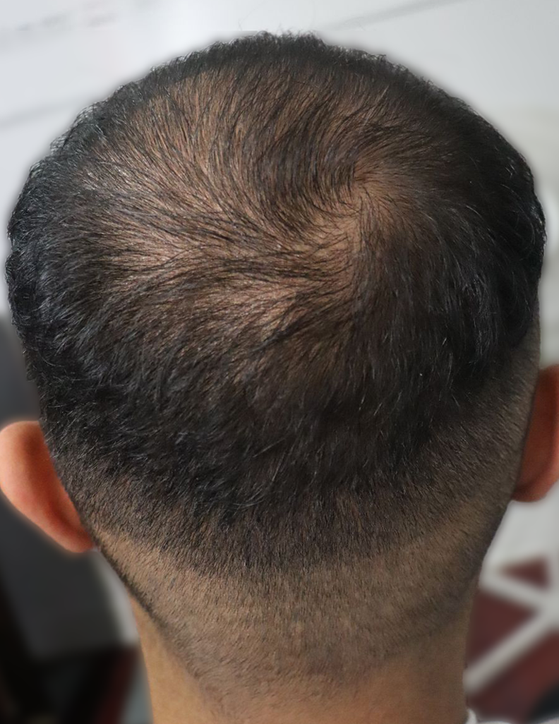 XYON and Minoxidil 12 Months of Topical Journey – NW 3 - Hair Loss ...