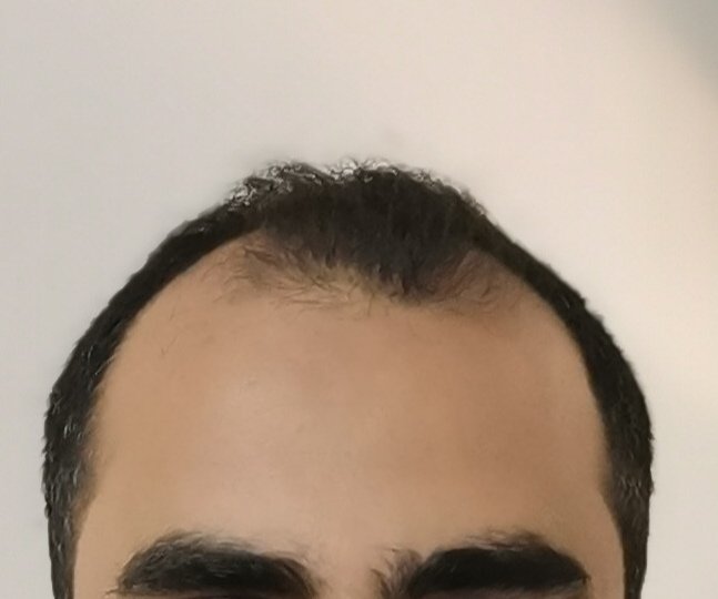 Advice about my temporal sides restoration - Hair Restoration Questions ...
