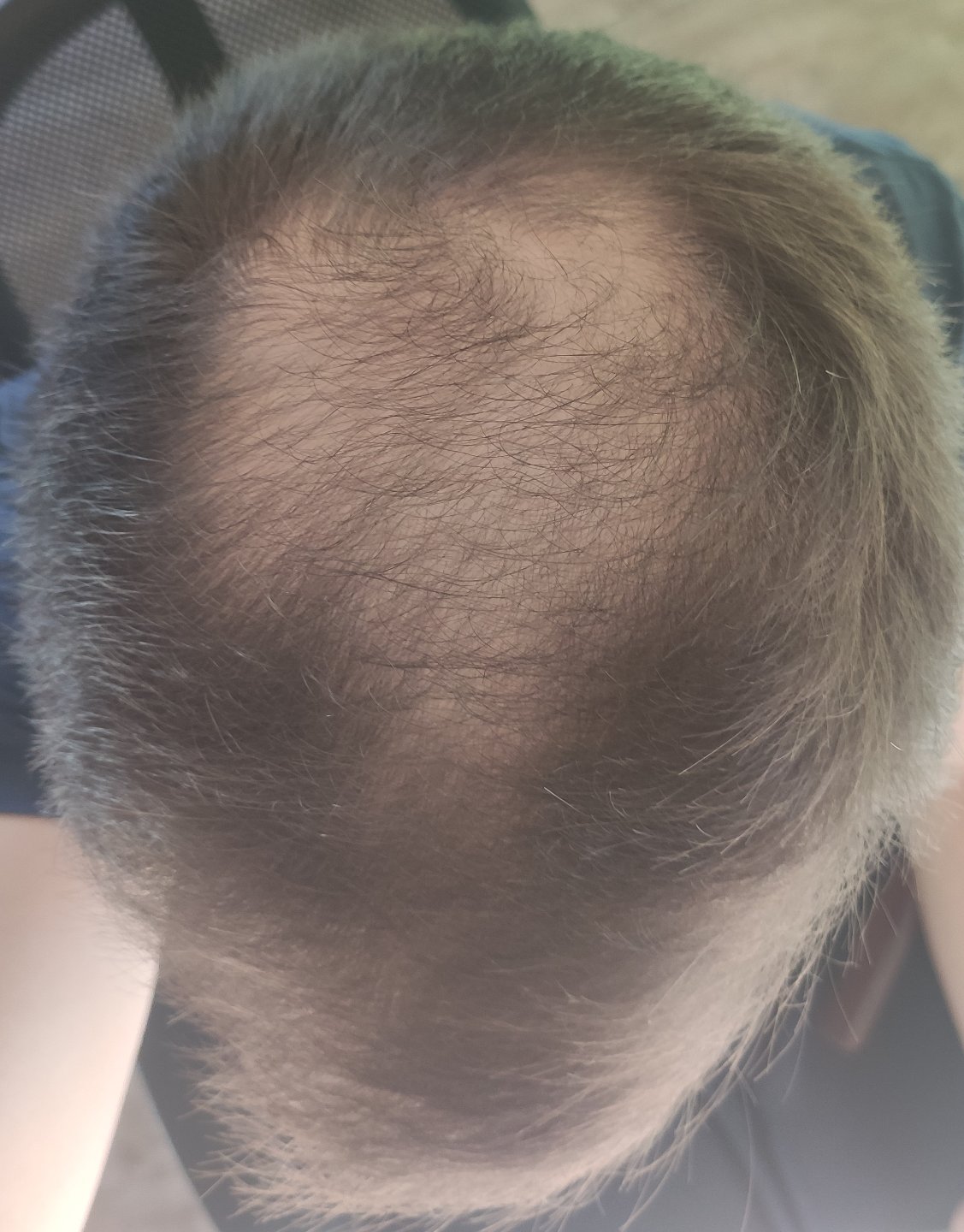 24M diffuse thinning, looking for a transplant - Hair Restoration ...