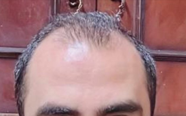 Advice about my temporal sides restoration - Hair Restoration Questions ...