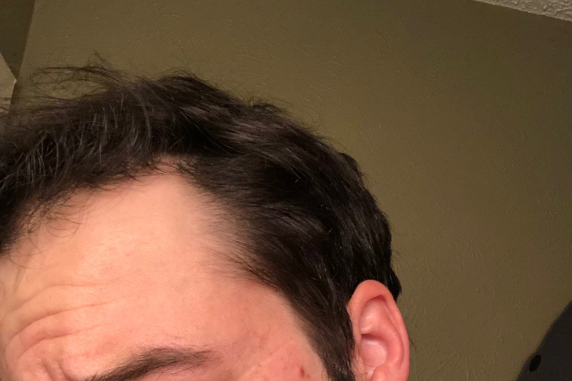 Lowering Hairline vs Filling in Corners (Pics Included) - Hair ...