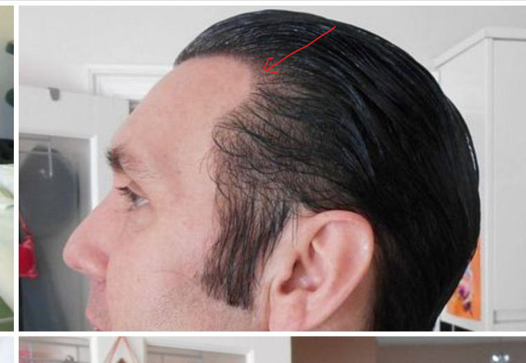 Advice about my temporal sides restoration - Hair Restoration Questions ...