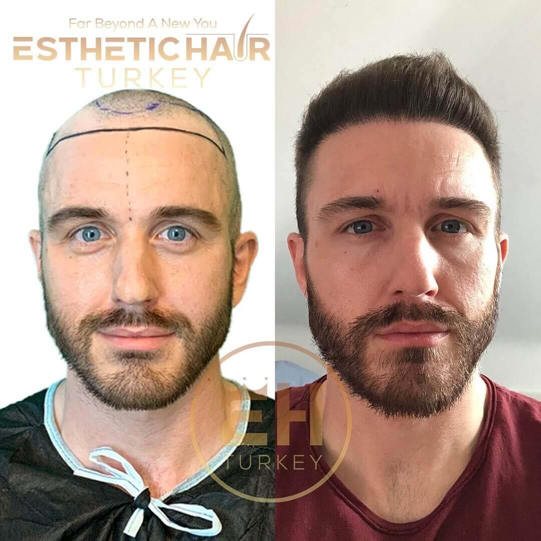 Esthetic Hair Turkey / Istanbul - Reviews? - Hair Transplant Reviews ...