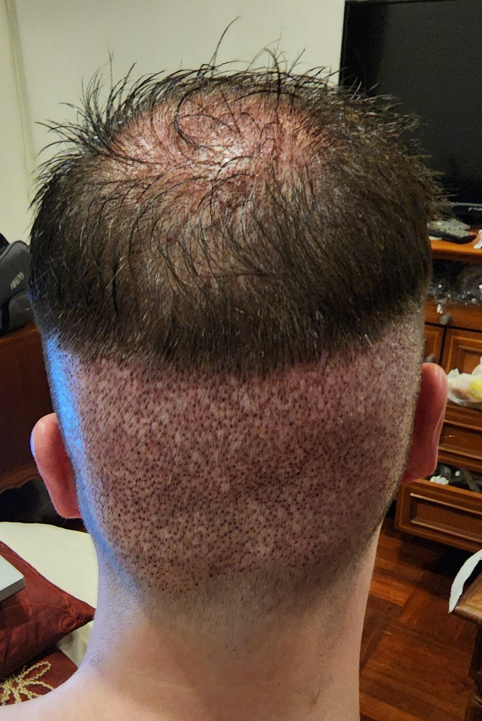 Just had a hair transplant but I have some concerns - Hair Restoration ...