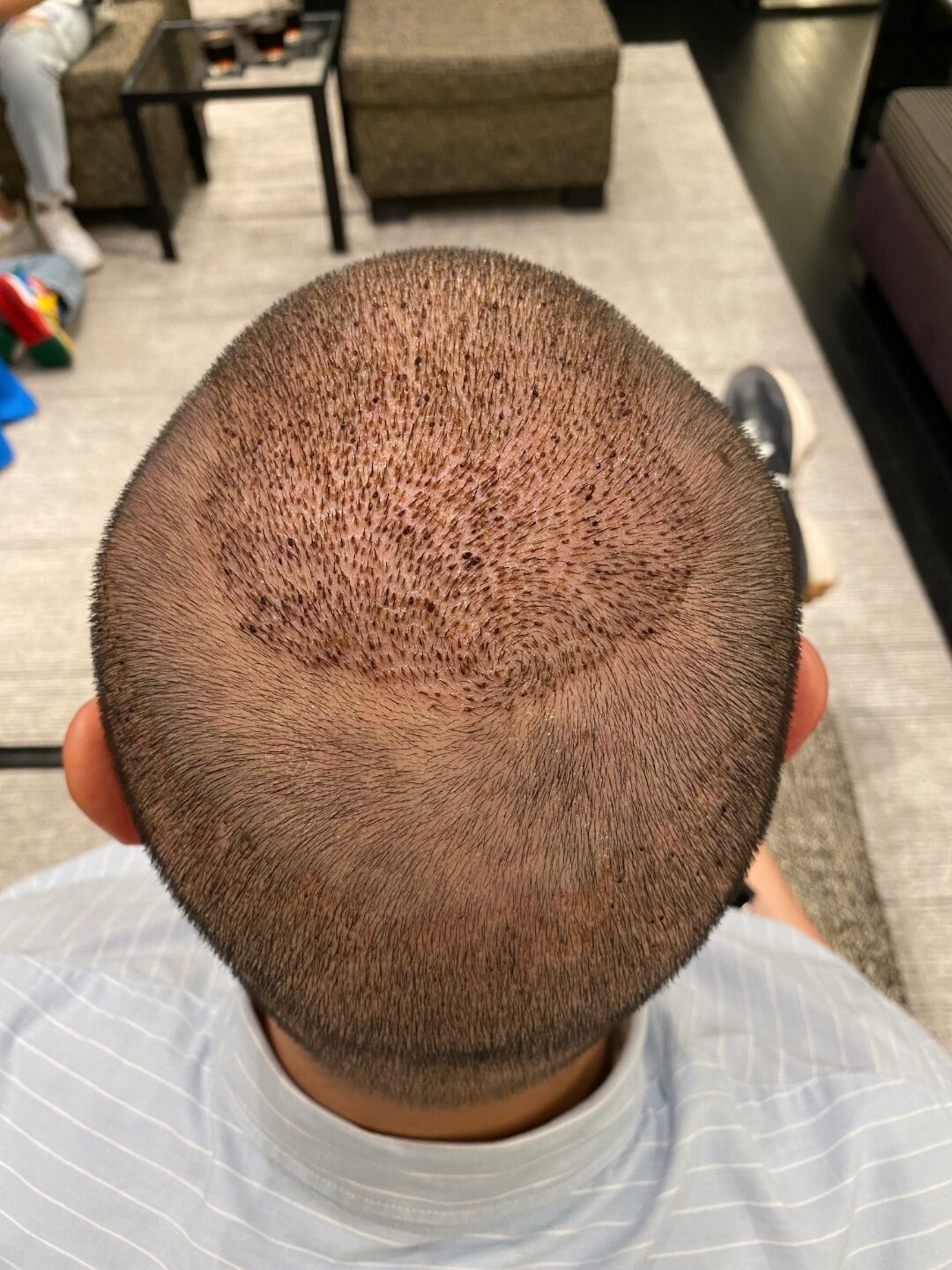 Dislodged Graft - Hair Restoration Questions and Answers - Hair ...