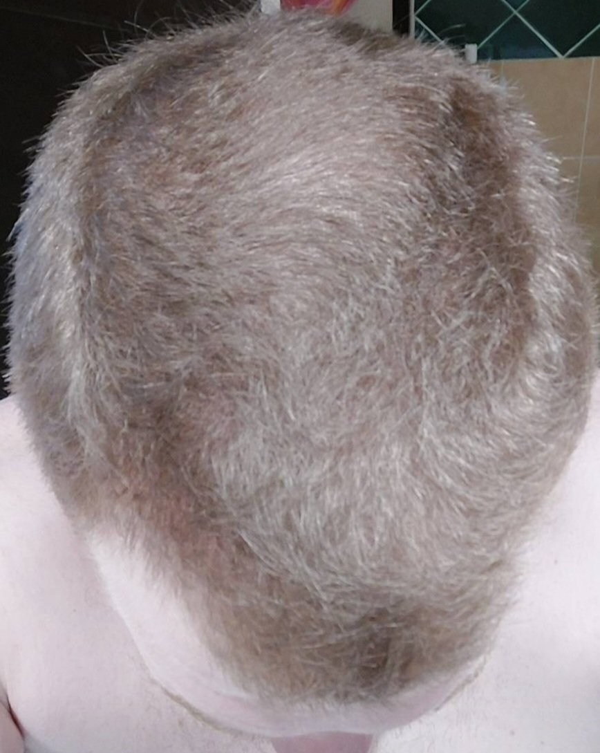 SMP to thicken hairline and mid scalp? (With longer hair) - Scalp ...