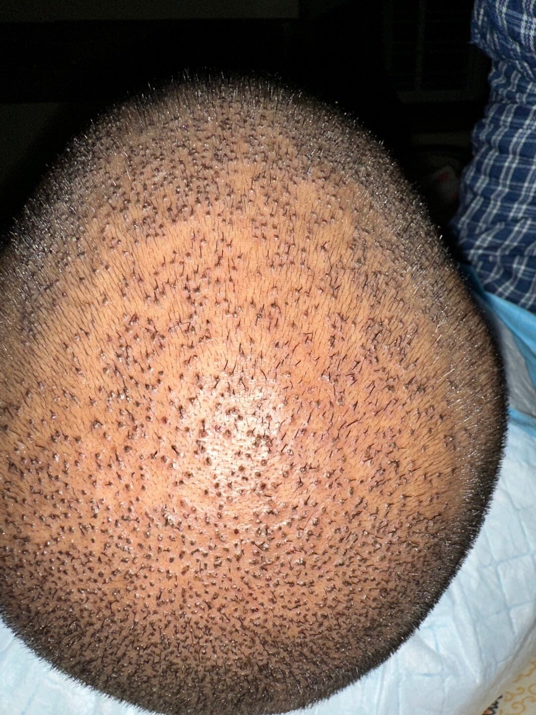 HELP..!!! Bumped into the car and dislodged 4 grafts visibly - Hair ...