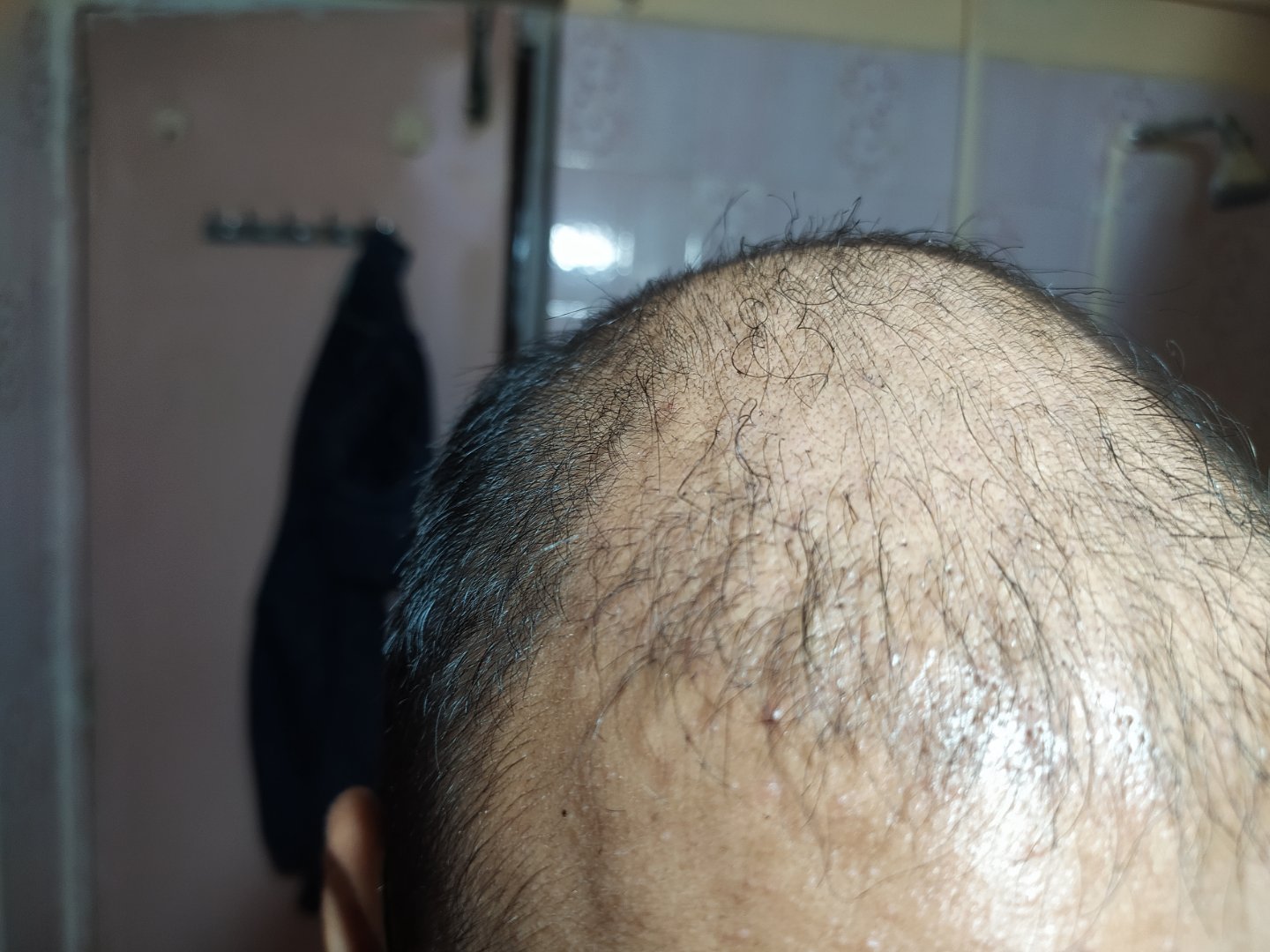What is hair direction just above the hair line? - Hair Restoration ...