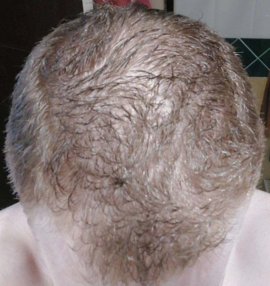 SMP to thicken hairline and mid scalp? (With longer hair) - Scalp ...