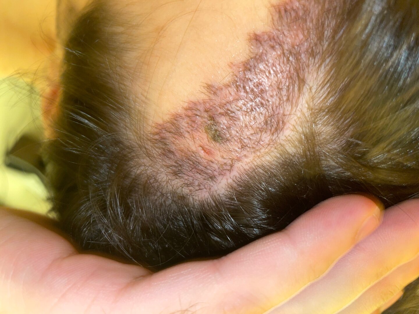 Is this hair dislodged? - Hair Restoration Questions and Answers - Hair ...