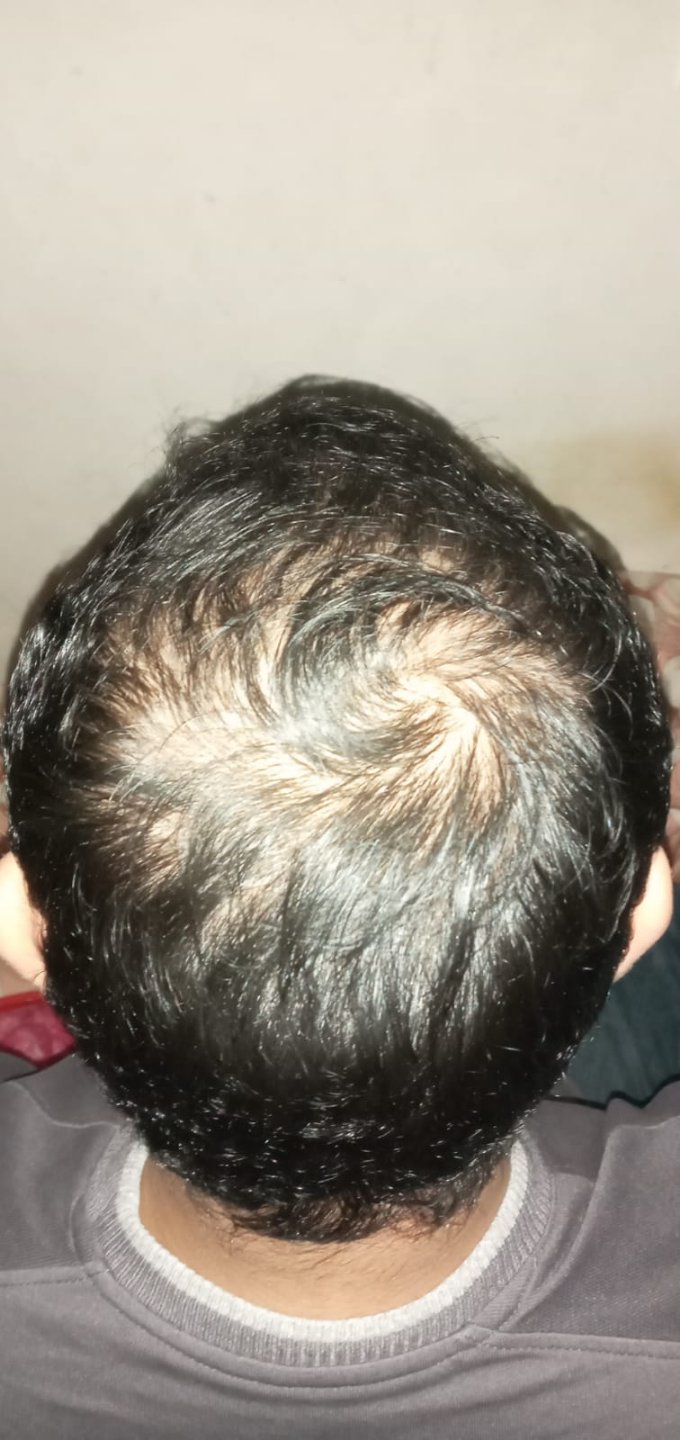 23 year old with aggressive hair loss - Hair Restoration Questions and ...