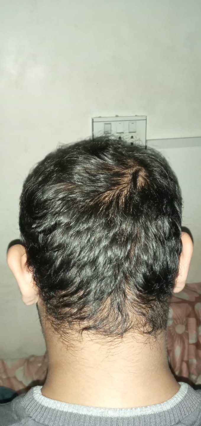 23 year old with aggressive hair loss - Hair Restoration Questions and ...